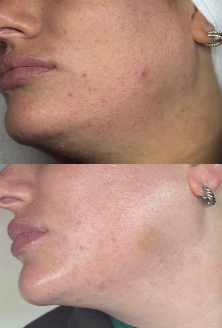 Acne Boot Camp - Revive